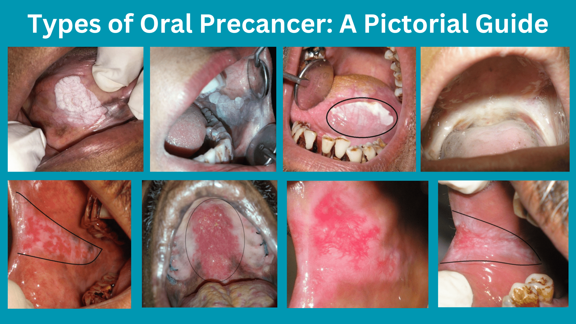 What is Oral Precancer? 10 Things You Need to Know