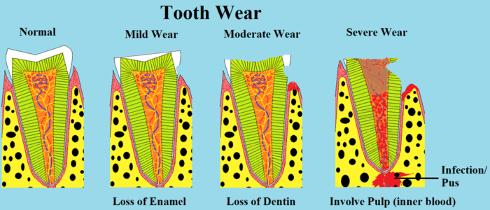 Understanding Teeth Wear and Tear: Causes, Symptoms, Prevention, and ...