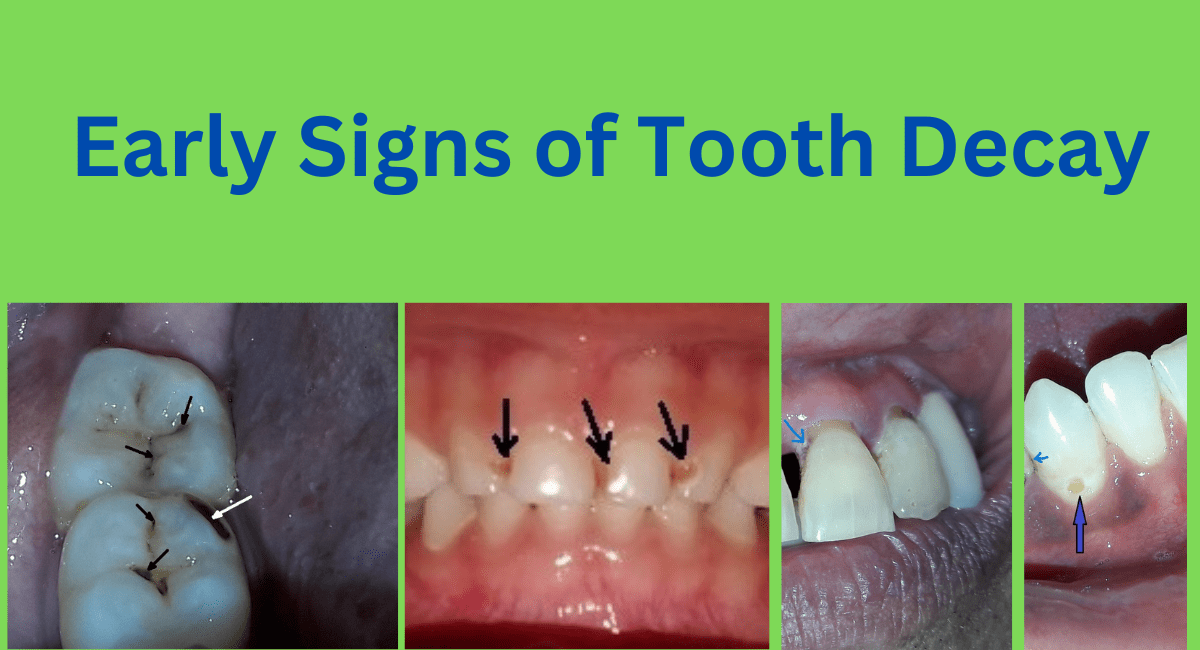 Early Signs of Tooth Decay: How to Detect and Prevent Cavities ...