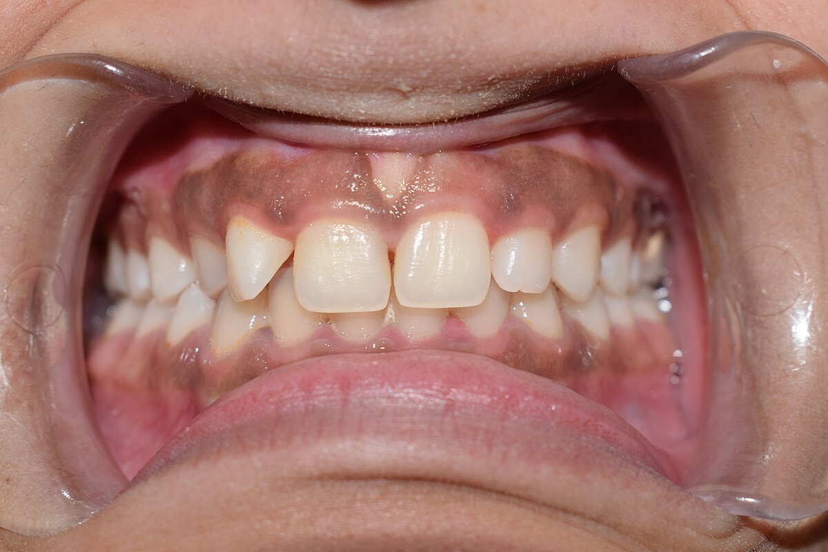 Gum Pigmentation: Harmless or a Hidden Health Warning? - Gateway of Health
