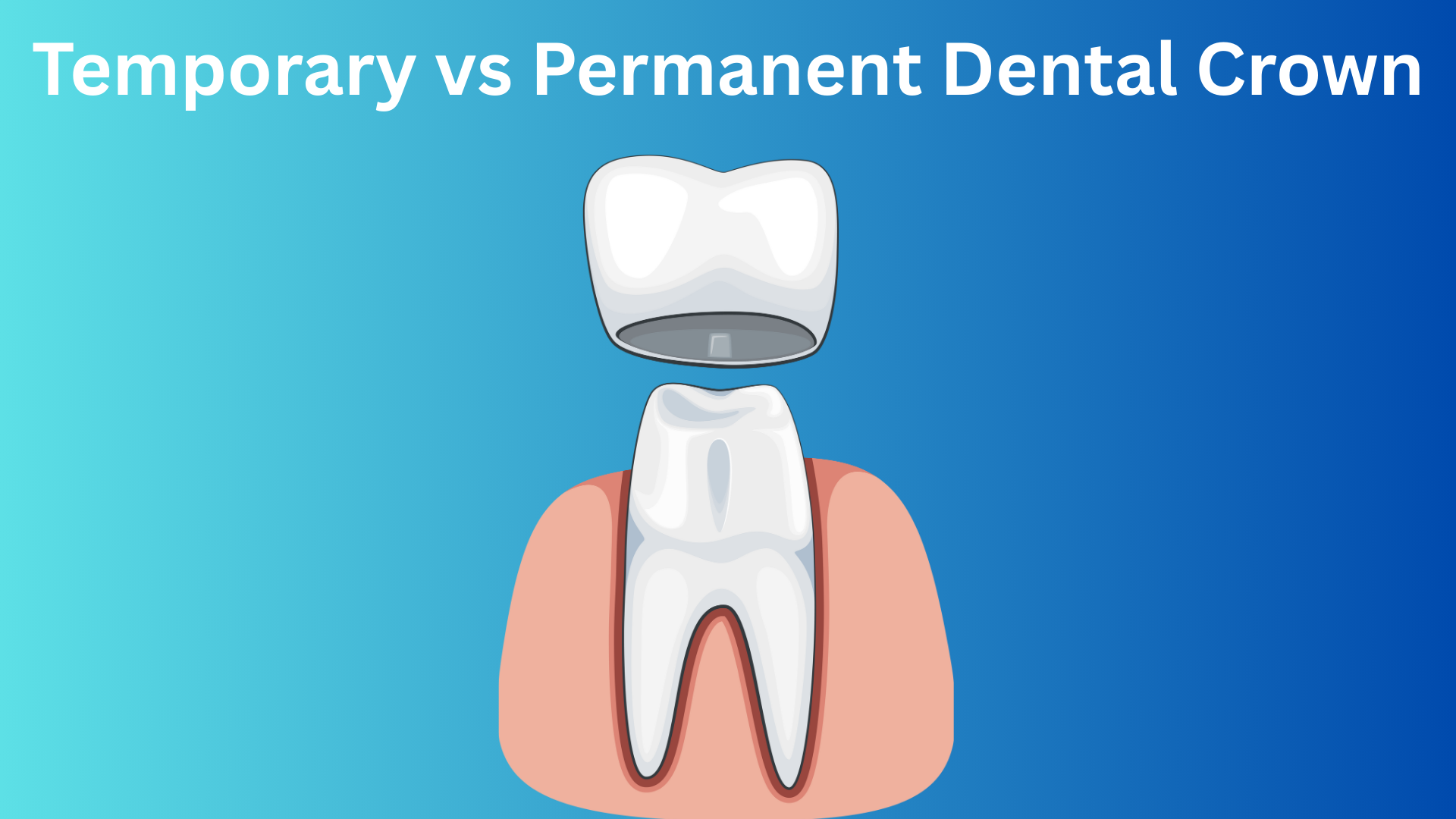 Temporary vs Permanent Dental Crown: Key Differences, Lifespan, Care ...
